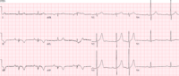 Reciprocal Changes and Occlusion MI | ECG Cases | Emergency Medicine Cases
