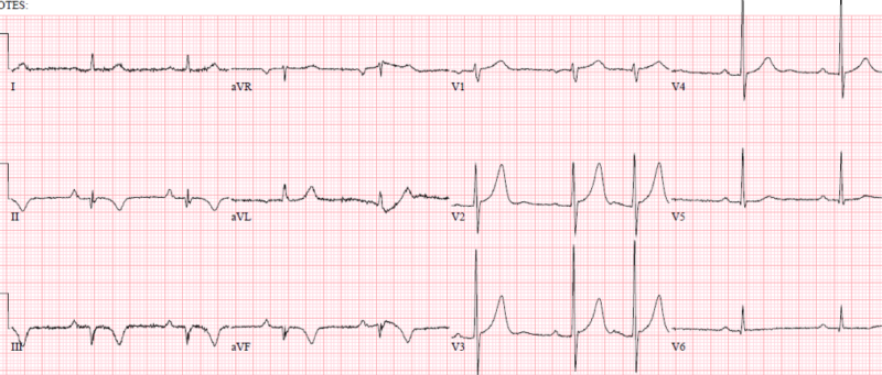 Reciprocal Changes and Occlusion MI | ECG Cases | Emergency Medicine Cases