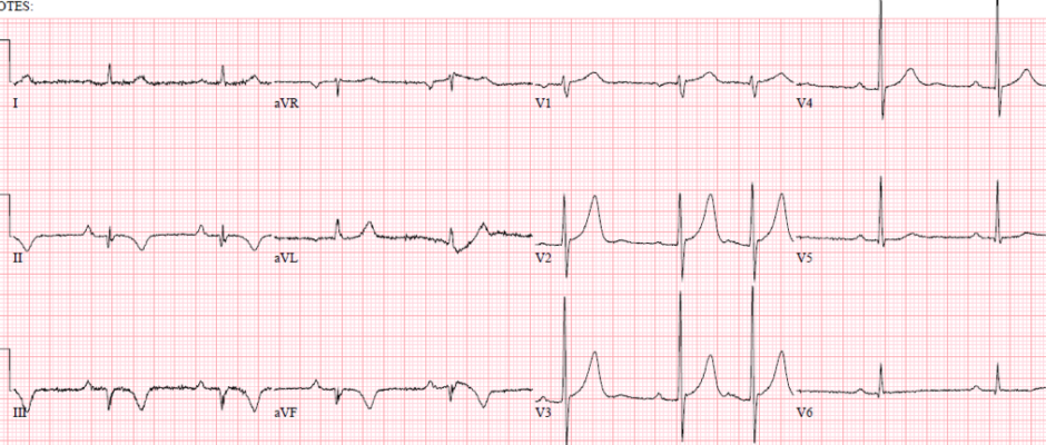 Reciprocal Changes and Occlusion MI | ECG Cases | Emergency Medicine Cases