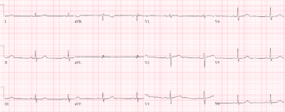 Reciprocal Changes and Occlusion MI | ECG Cases | Emergency Medicine Cases