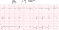 Reciprocal Changes and Occlusion MI | ECG Cases | Emergency Medicine Cases