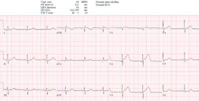 Reciprocal Changes and Occlusion MI | ECG Cases | Emergency Medicine Cases