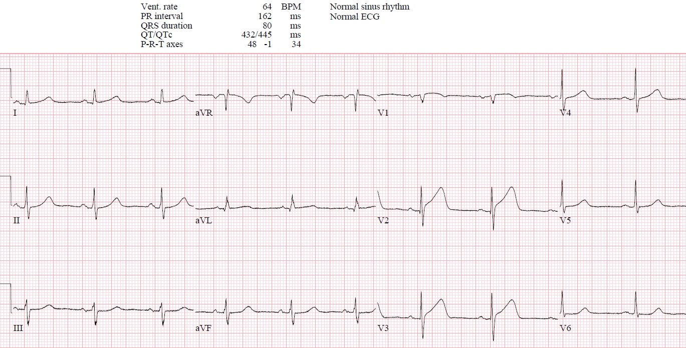 Reciprocal Changes and Occlusion MI | ECG Cases | Emergency Medicine Cases