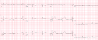 Reciprocal Changes and Occlusion MI | ECG Cases | Emergency Medicine Cases