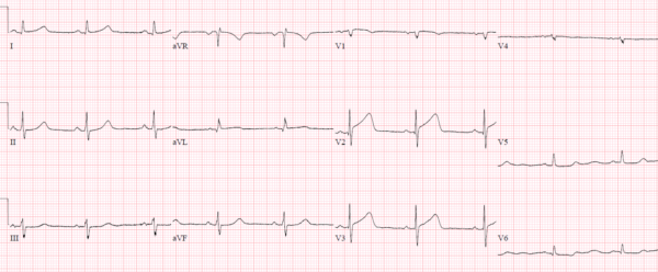 Reciprocal Changes and Occlusion MI | ECG Cases | Emergency Medicine Cases