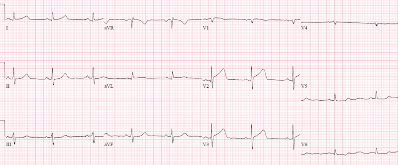 Reciprocal Changes and Occlusion MI | ECG Cases | Emergency Medicine Cases