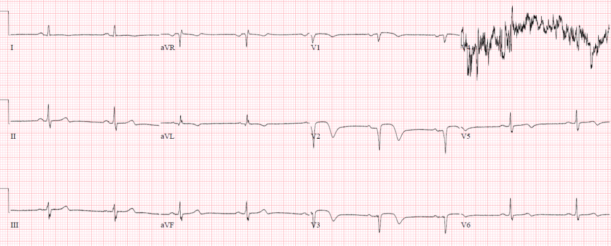 Reciprocal Changes and Occlusion MI | ECG Cases | Emergency Medicine Cases