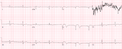 Reciprocal Changes and Occlusion MI | ECG Cases | Emergency Medicine Cases