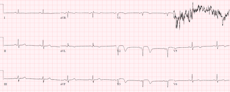 Reciprocal Changes and Occlusion MI | ECG Cases | Emergency Medicine Cases