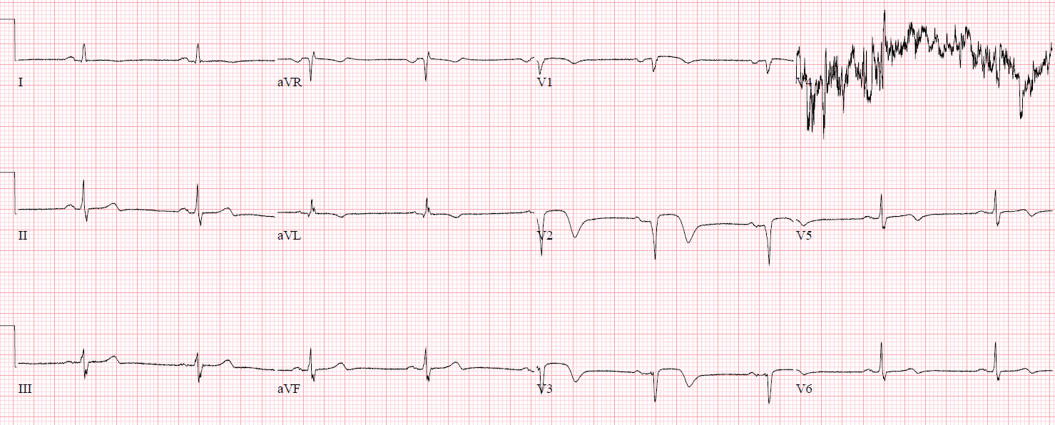 Reciprocal Changes and Occlusion MI | ECG Cases | Emergency Medicine Cases
