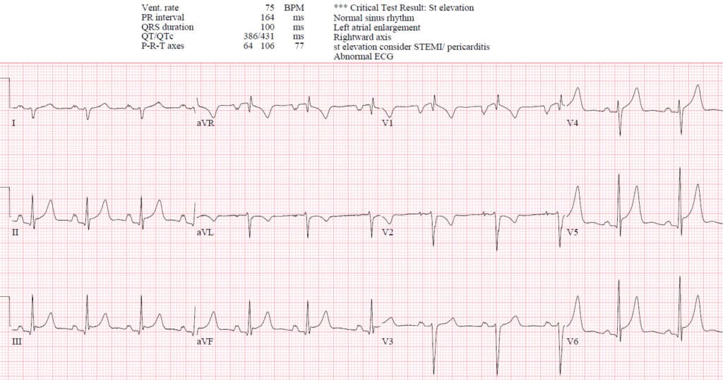 Reciprocal Changes and Occlusion MI | ECG Cases | Emergency Medicine Cases