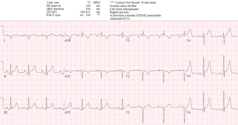 Reciprocal Changes and Occlusion MI | ECG Cases | Emergency Medicine Cases