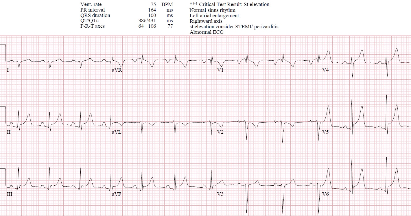 Reciprocal Changes and Occlusion MI | ECG Cases | Emergency Medicine Cases