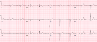 Reciprocal Changes and Occlusion MI | ECG Cases | Emergency Medicine Cases