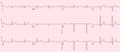 Reciprocal Changes and Occlusion MI | ECG Cases | Emergency Medicine Cases