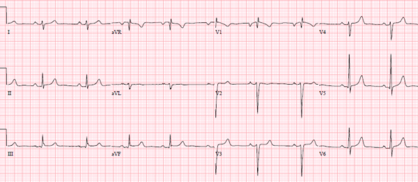 Reciprocal Changes and Occlusion MI | ECG Cases | Emergency Medicine Cases