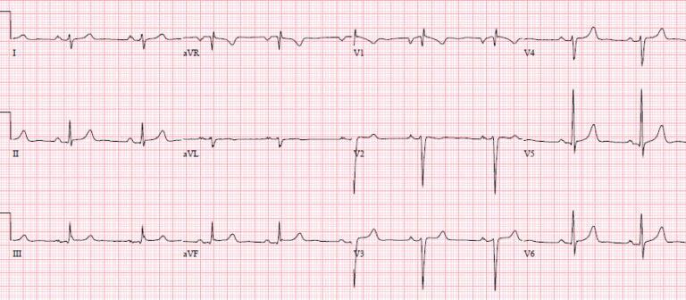 Reciprocal Changes and Occlusion MI | ECG Cases | Emergency Medicine Cases