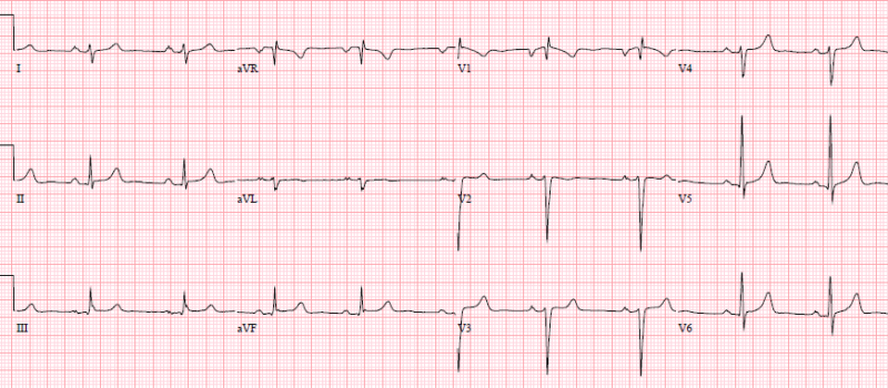 Reciprocal Changes and Occlusion MI | ECG Cases | Emergency Medicine Cases