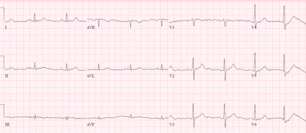 Reciprocal Changes and Occlusion MI | ECG Cases | Emergency Medicine Cases