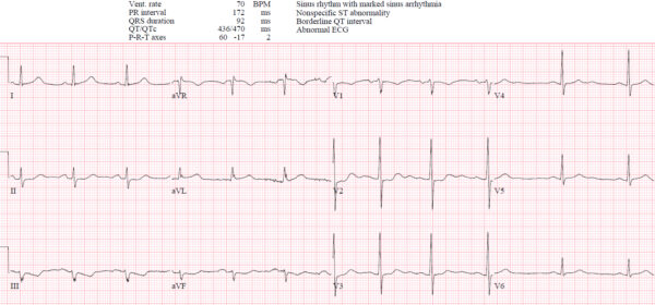 Reciprocal Changes and Occlusion MI | ECG Cases | Emergency Medicine Cases