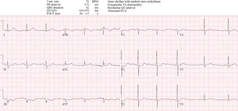 Reciprocal Changes and Occlusion MI | ECG Cases | Emergency Medicine Cases