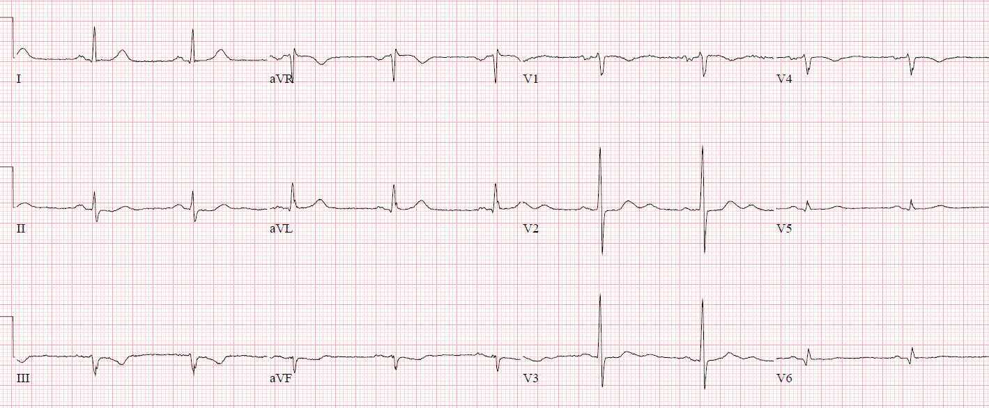Reciprocal Changes and Occlusion MI | ECG Cases | Emergency Medicine Cases