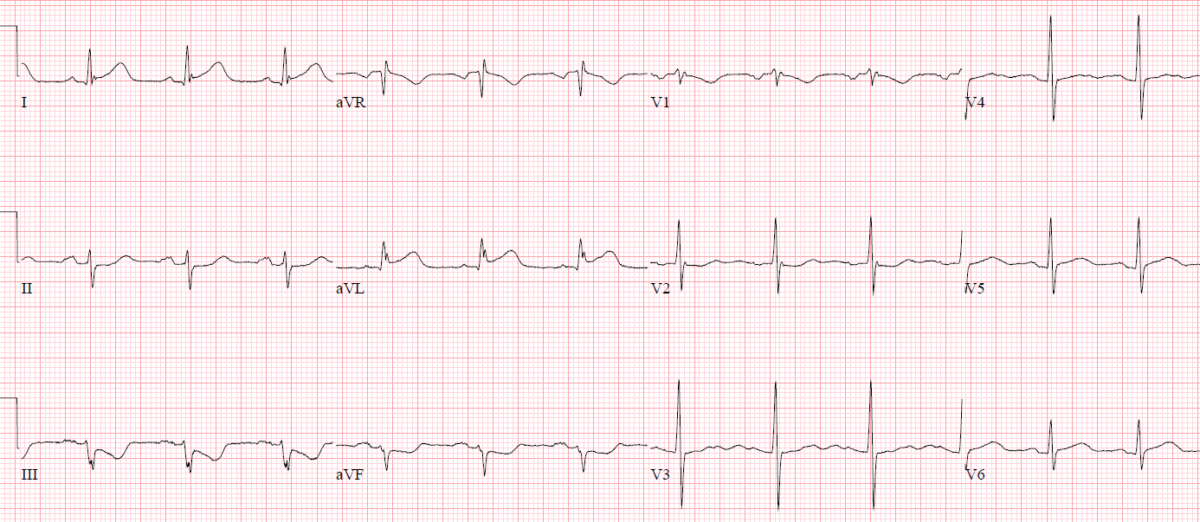 Reciprocal Changes and Occlusion MI | ECG Cases | Emergency Medicine Cases