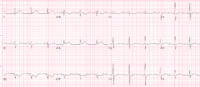 Reciprocal Changes and Occlusion MI | ECG Cases | Emergency Medicine Cases