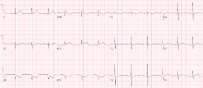 Reciprocal Changes and Occlusion MI | ECG Cases | Emergency Medicine Cases
