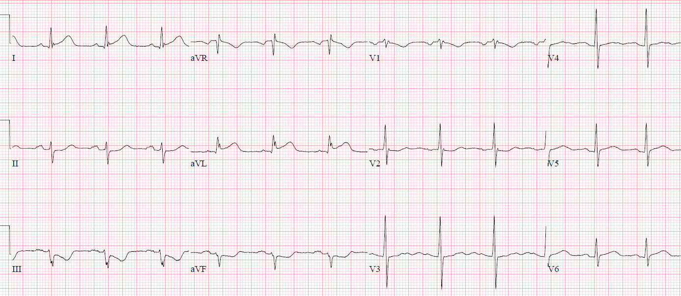 Reciprocal Changes and Occlusion MI | ECG Cases | Emergency Medicine Cases