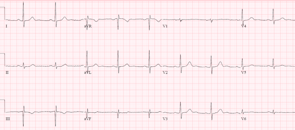 Reciprocal Changes and Occlusion MI | ECG Cases | Emergency Medicine Cases