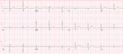 Reciprocal Changes and Occlusion MI | ECG Cases | Emergency Medicine Cases