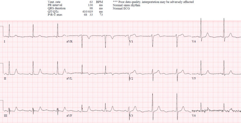 Reciprocal Changes and Occlusion MI | ECG Cases | Emergency Medicine Cases
