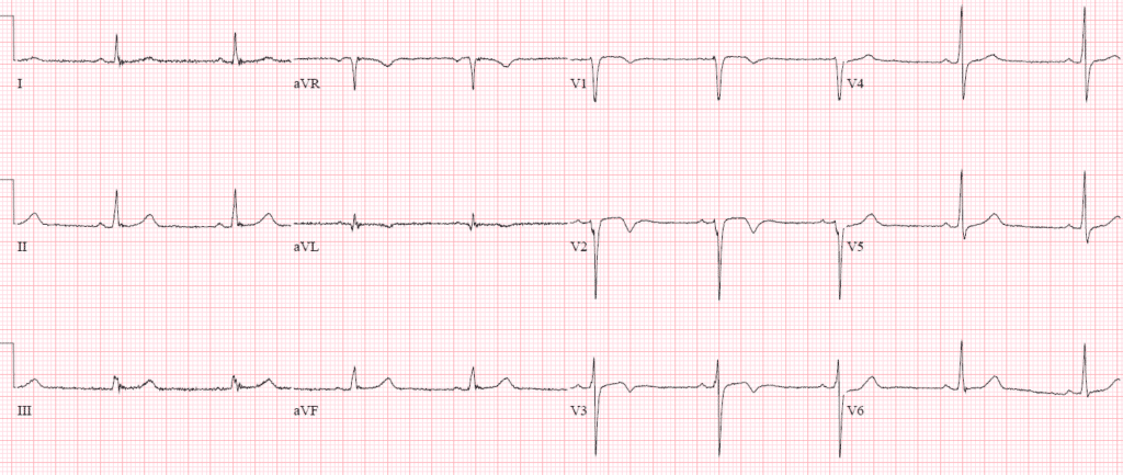 Reciprocal Changes and Occlusion MI | ECG Cases | Emergency Medicine Cases
