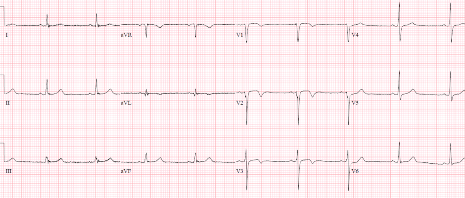 Reciprocal Changes and Occlusion MI | ECG Cases | Emergency Medicine Cases
