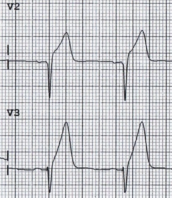 NG Tubes in SBO, Hyperacute T-Waves, Malignant Otitis Externa, CCTA in ...