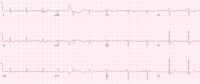 Pulmonary embolism and acute RV strain | ECG Cases 26 | EM Cases