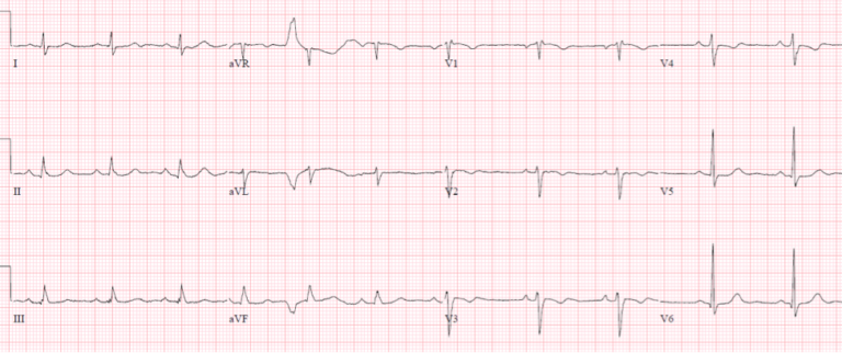 Pulmonary embolism and acute RV strain | ECG Cases 26 | EM Cases