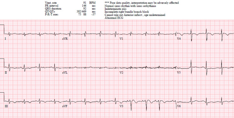 Pulmonary embolism and acute RV strain | ECG Cases 26 | EM Cases
