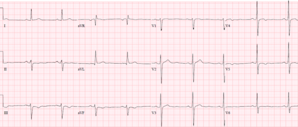 Pulmonary embolism and acute RV strain | ECG Cases 26 | EM Cases