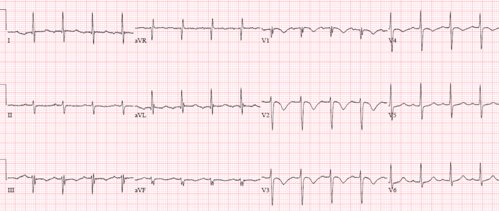 Pulmonary embolism and acute RV strain | ECG Cases 26 | EM Cases