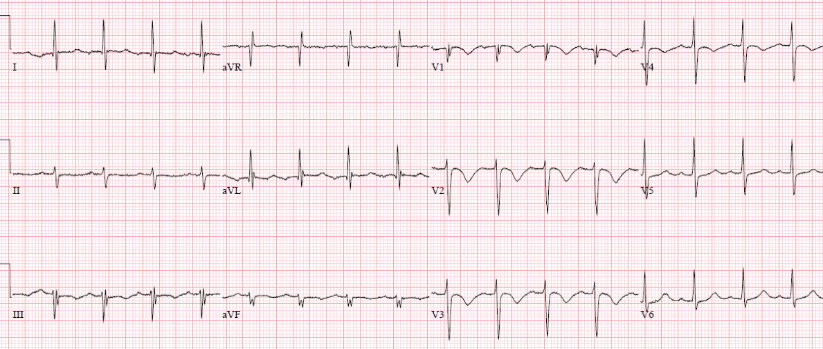 Pulmonary embolism and acute RV strain | ECG Cases 26 | EM Cases