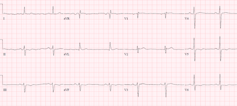 Pulmonary embolism and acute RV strain | ECG Cases 26 | EM Cases