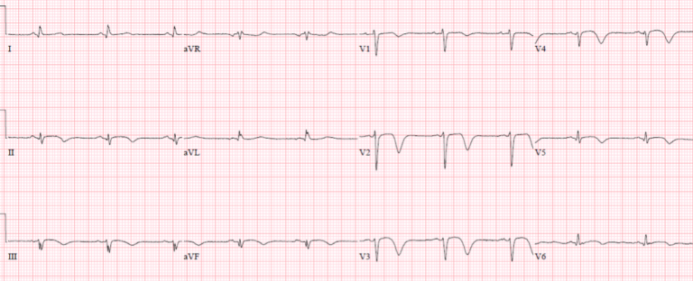 Pulmonary embolism and acute RV strain | ECG Cases 26 | EM Cases