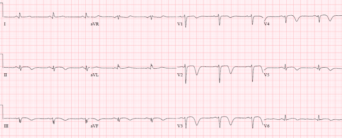 Pulmonary embolism and acute RV strain | ECG Cases 26 | EM Cases