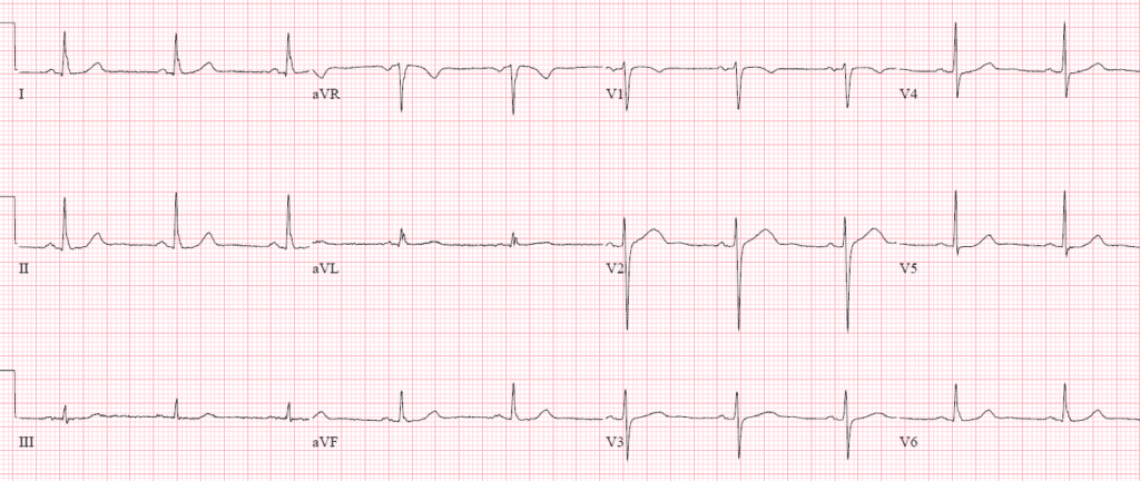 Pulmonary embolism and acute RV strain | ECG Cases 26 | EM Cases