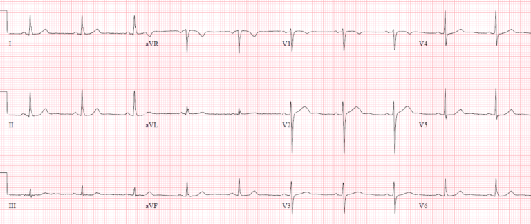 Pulmonary embolism and acute RV strain | ECG Cases 26 | EM Cases