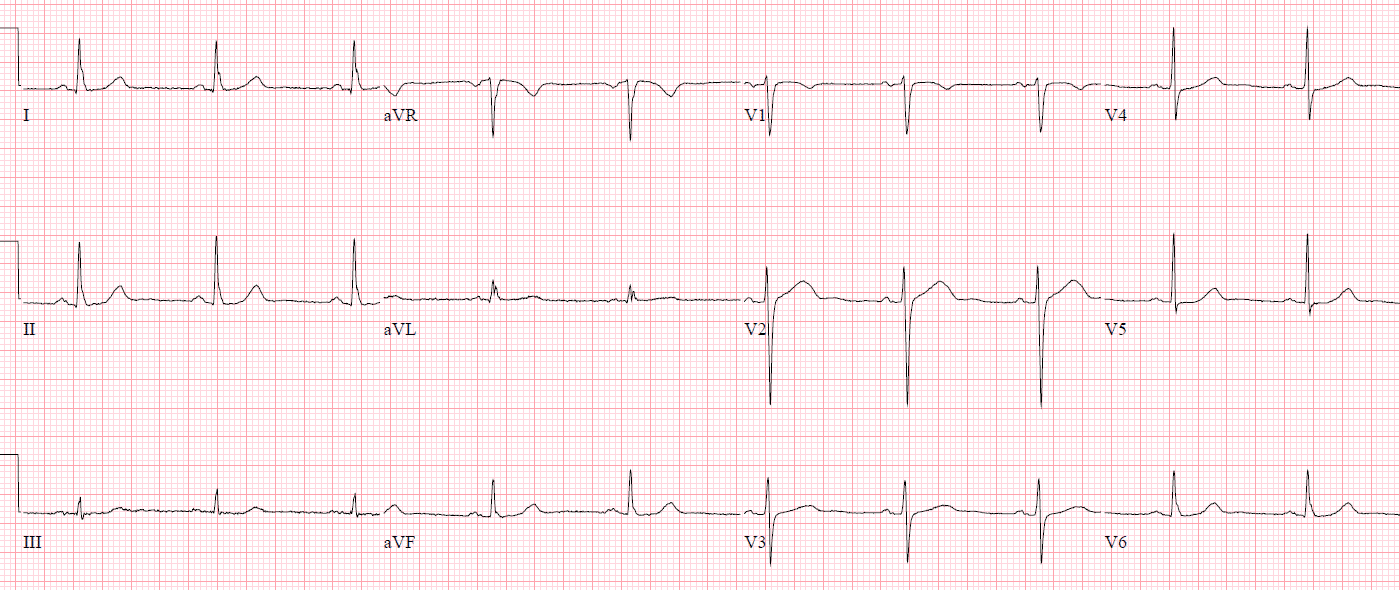 Pulmonary embolism and acute RV strain | ECG Cases 26 | EM Cases