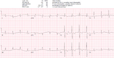 Pulmonary embolism and acute RV strain | ECG Cases 26 | EM Cases