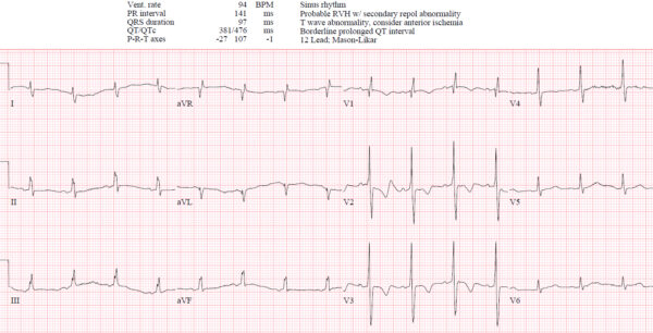 Pulmonary embolism and acute RV strain | ECG Cases 26 | EM Cases